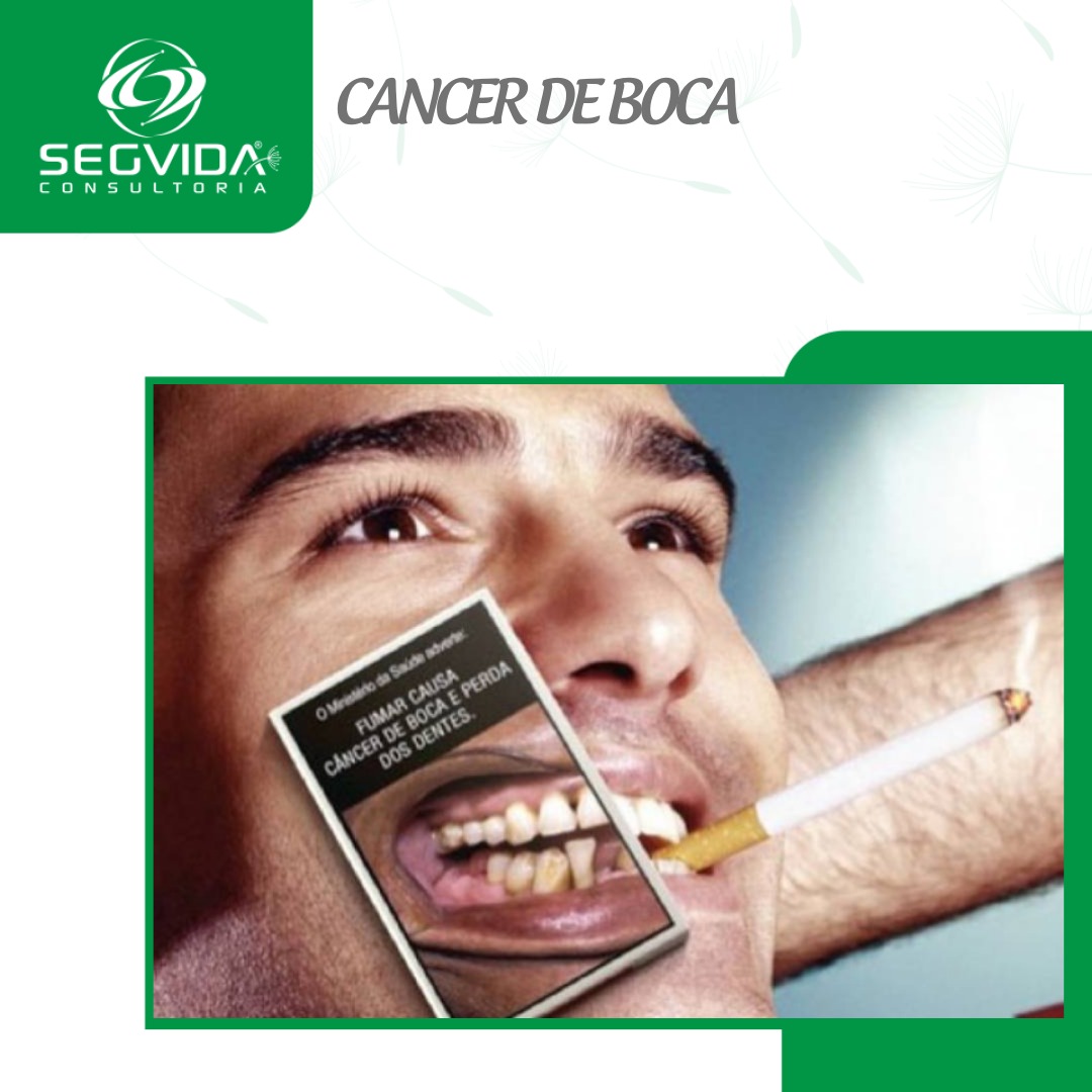 CÂNCER DE BOCA: O QUE É, SINTOMAS, CAUSAS E TRATAMENTO! • Segvida